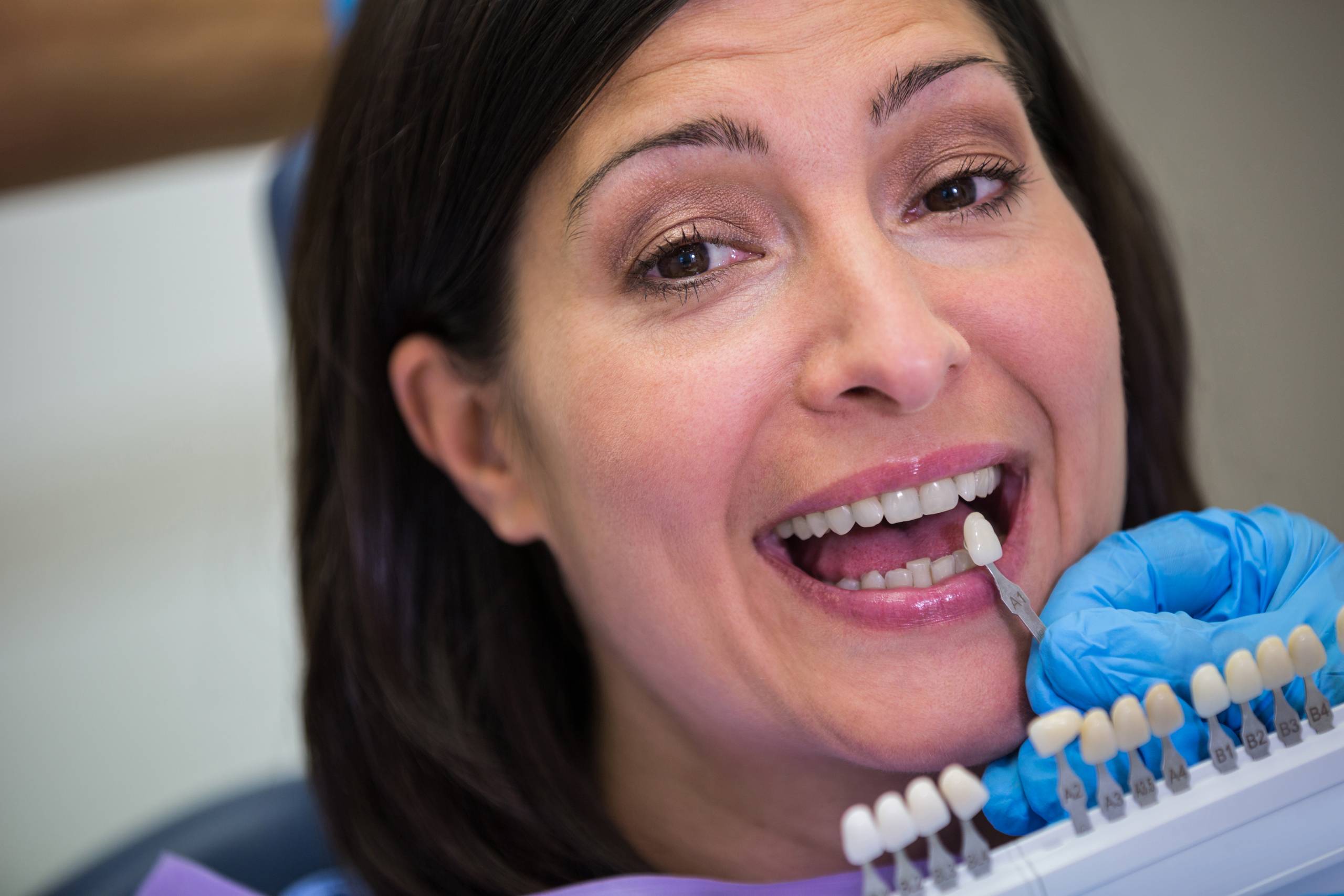 Patient Case Study: Smile Correction with Emax Veneers