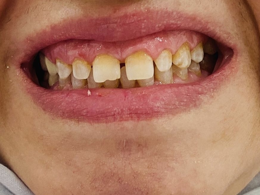 Patient Case Study: Smile Correction with Emax Veneers